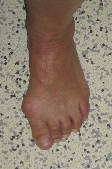 Hallux valgus – Wuppertaler Fuß – Initiative