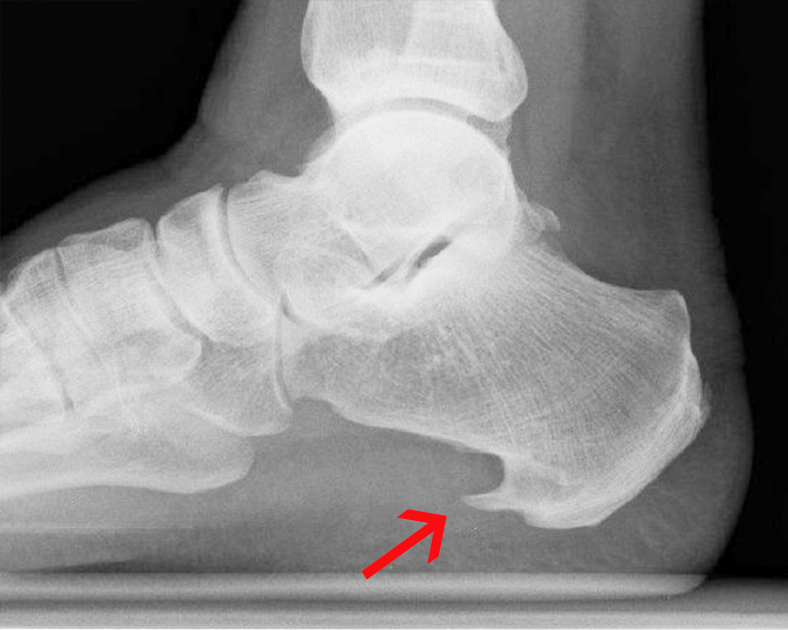 Fersensporn (Plantarfasziitis) – Wuppertaler Fuß – Initiative