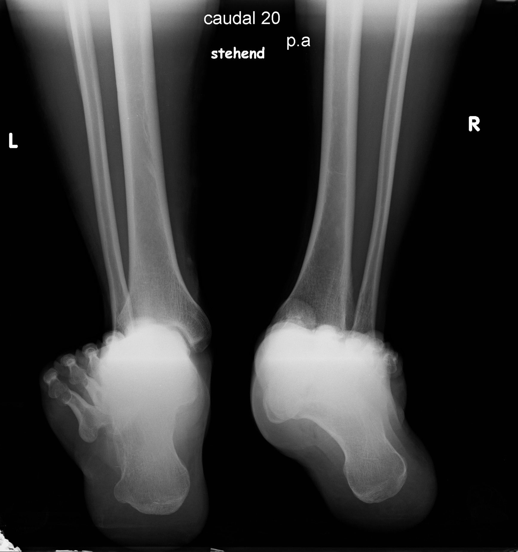 Der Plattfuß des Erwachsenen – Wuppertaler Fuß – Initiative