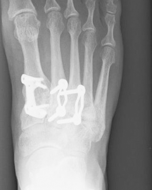 Lisfranc-Arthrodese – Wuppertaler Fuß – Initiative