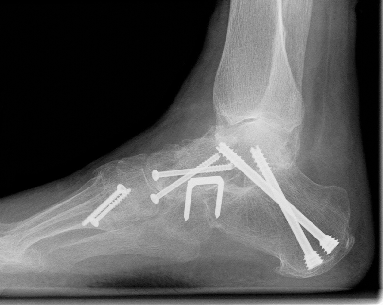 Arthrodese des unteren Sprunggelenks – Wuppertaler Fuß – Initiative