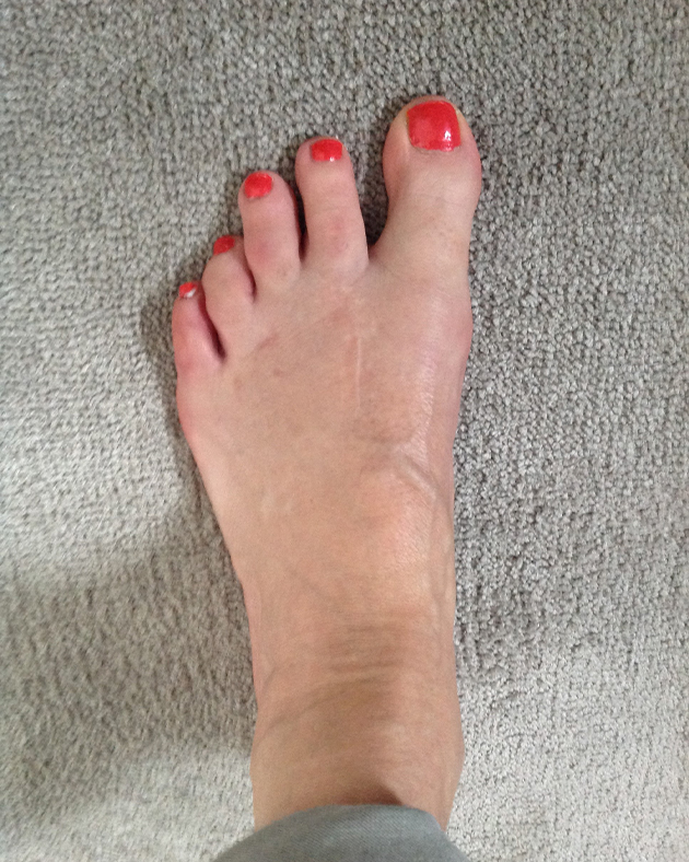 Hammerzehe – Wuppertaler Fuß – Initiative