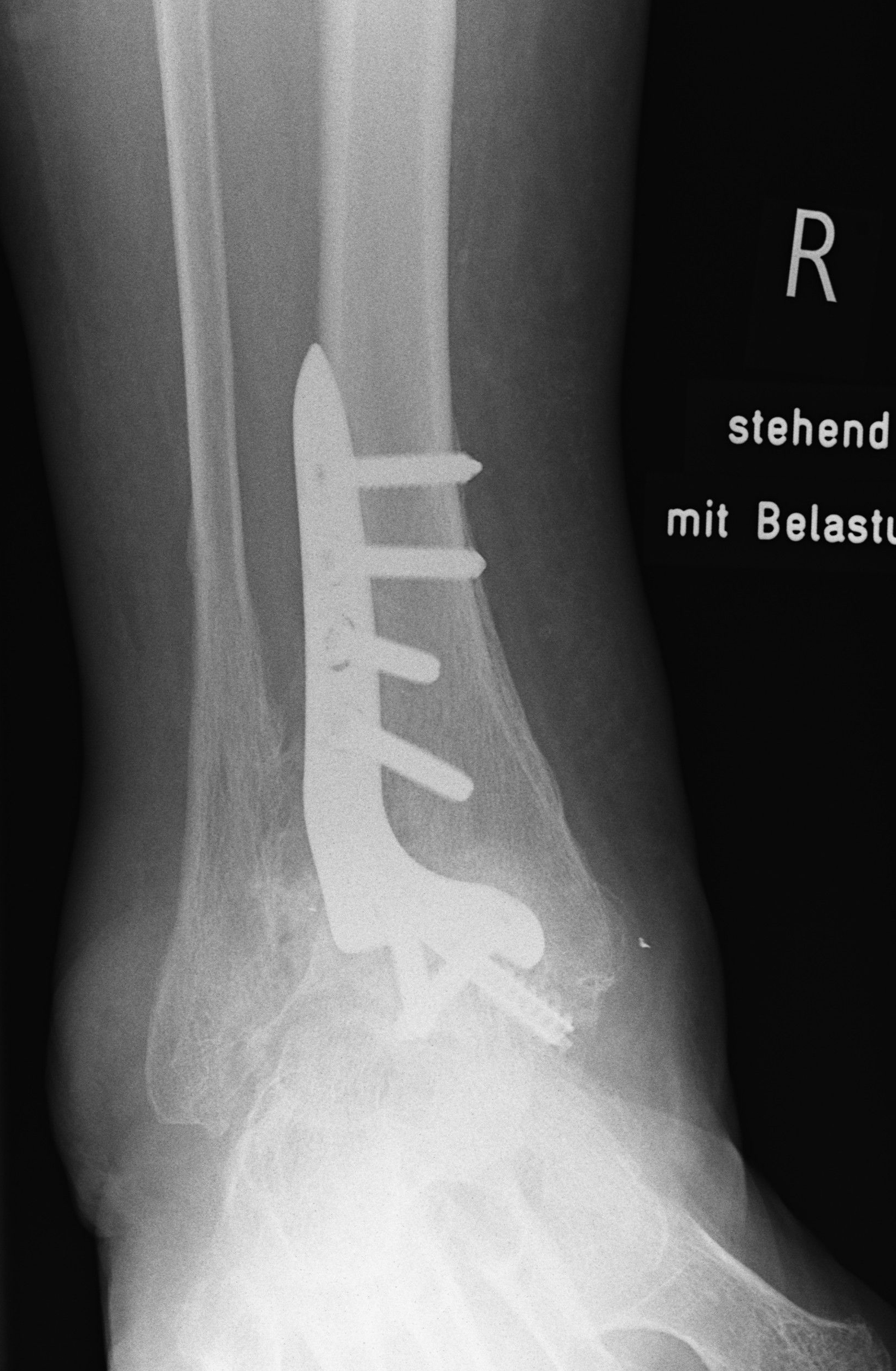 OSG-Arthrodese – Wuppertaler Fuß – Initiative