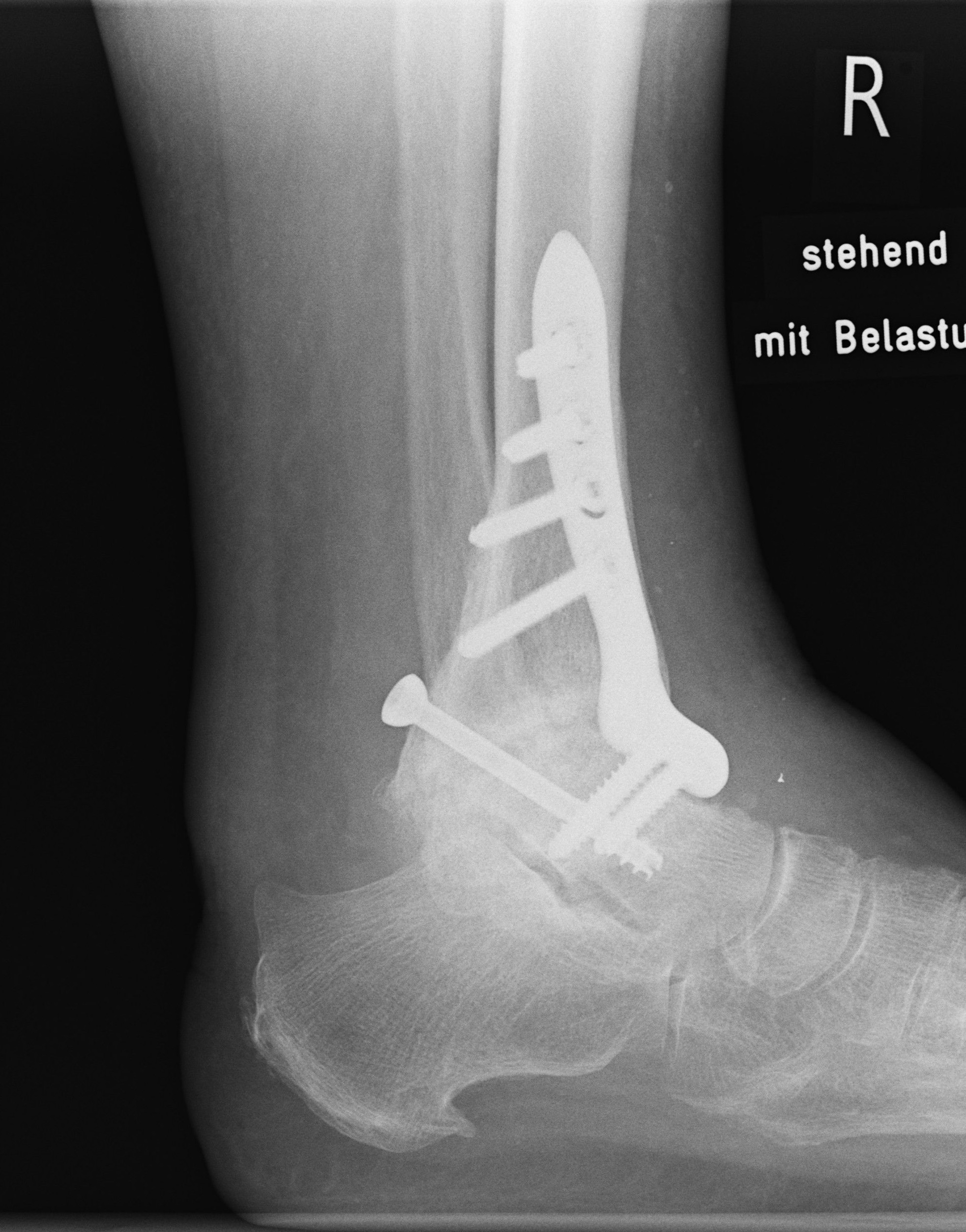 OSG-Arthrodese – Wuppertaler Fuß – Initiative