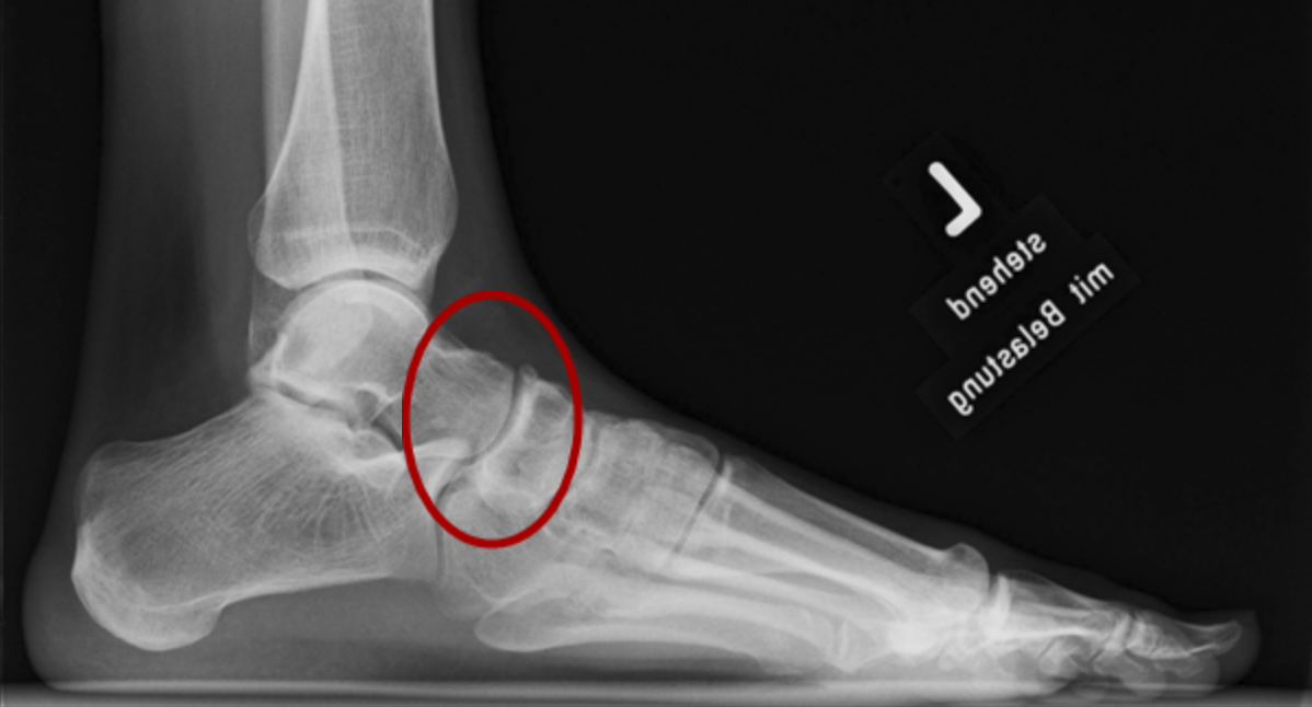 Talonavicular-Arthrodese – Wuppertaler Fuß – Initiative