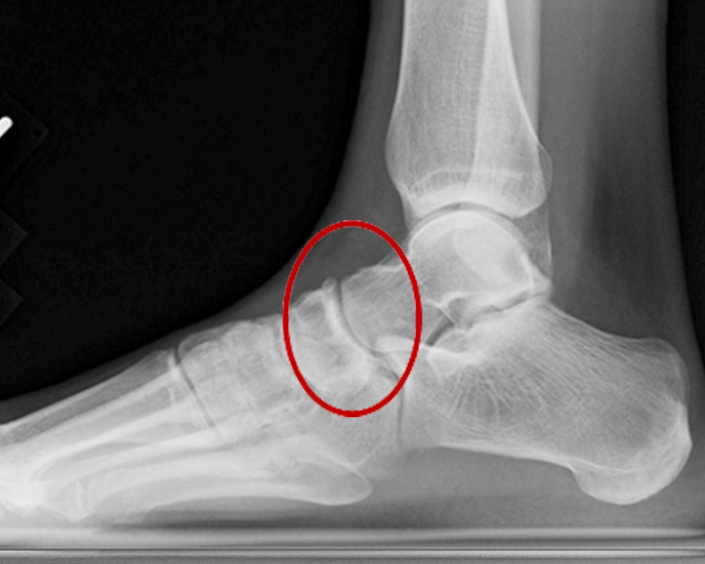 Hallux Rigidus Cartiva – Wuppertaler Fuß – Initiative