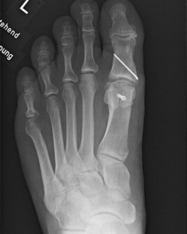 Moberg-Operation – Wuppertaler Fuß – Initiative