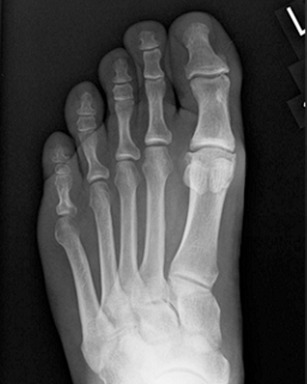 Youngswick-Operation – Wuppertaler Fuß – Initiative