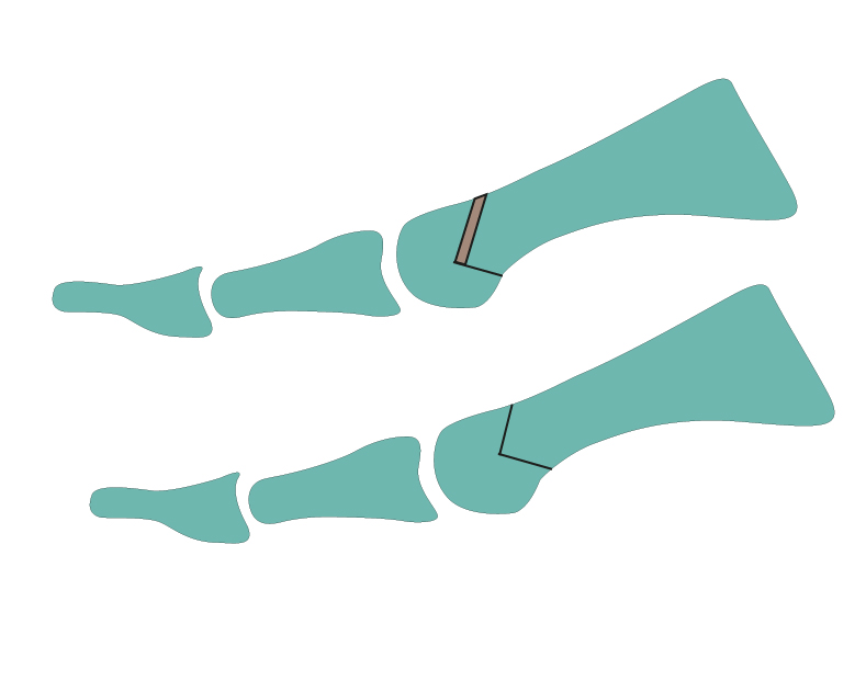 Youngswick-Operation – Wuppertaler Fuß – Initiative