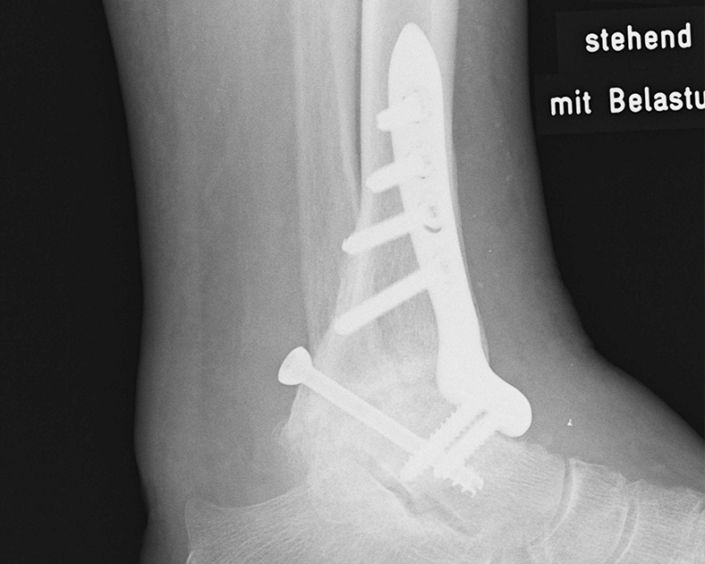 Hallux Rigidus Cartiva – Wuppertaler Fuß – Initiative