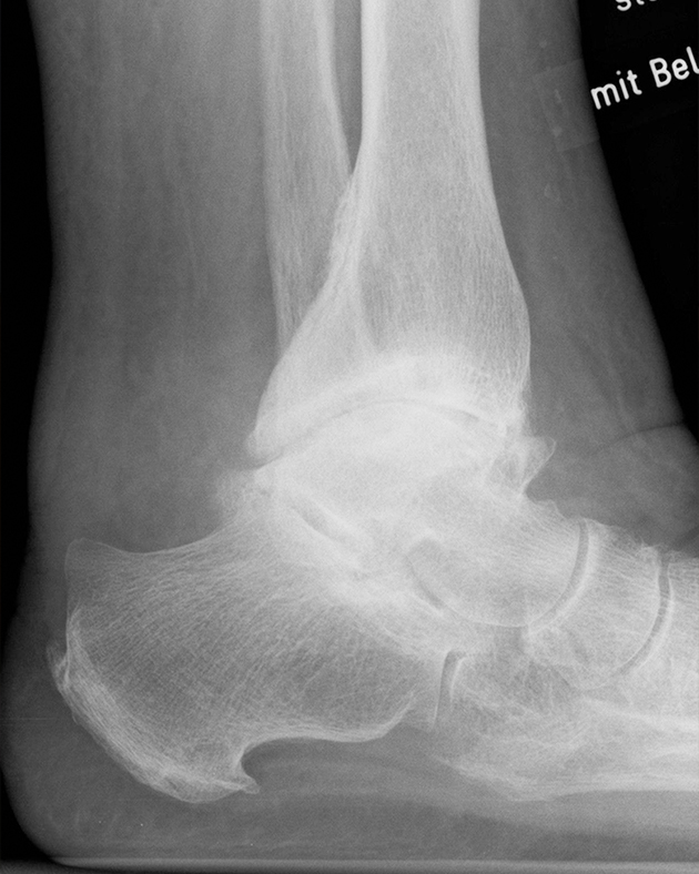 Arthrodese OSG – Wuppertaler Fuß – Initiative