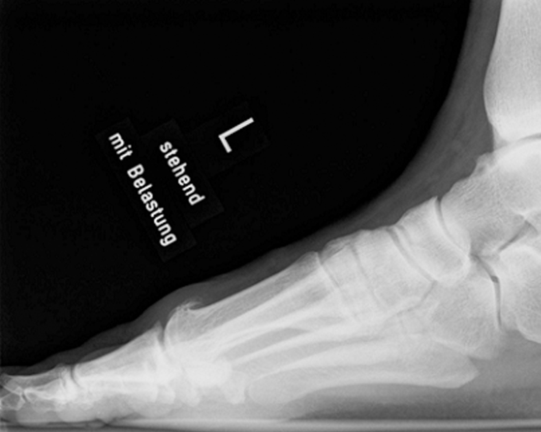 Youngswick-Operation – Wuppertaler Fuß – Initiative