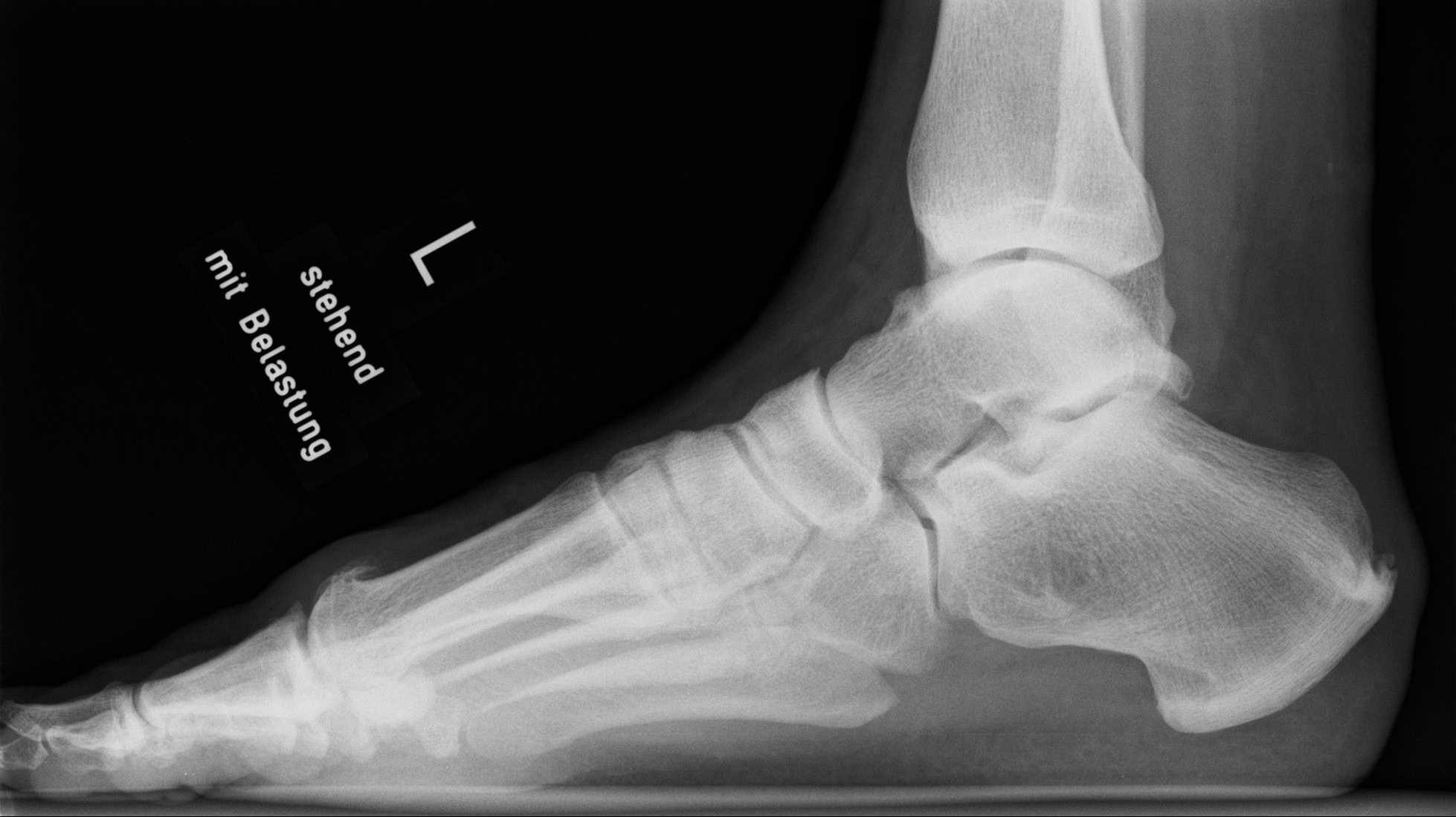 Youngswick-Operation – Wuppertaler Fuß – Initiative