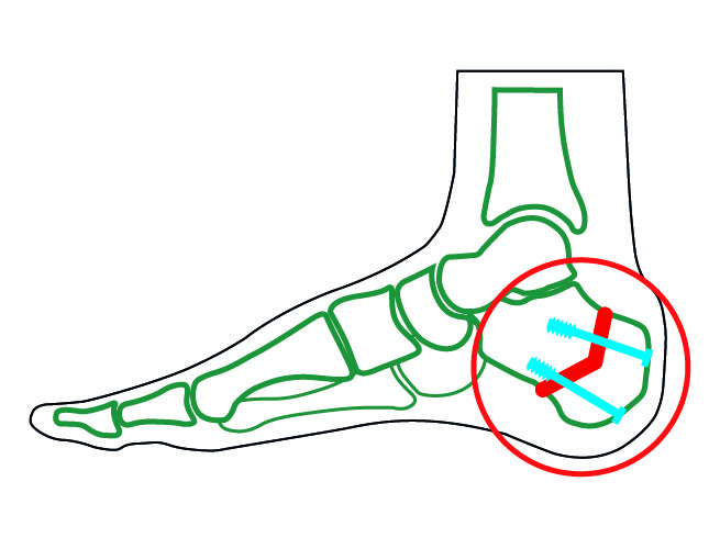 Talonavicular-Arthrodese – Wuppertaler Fuß – Initiative