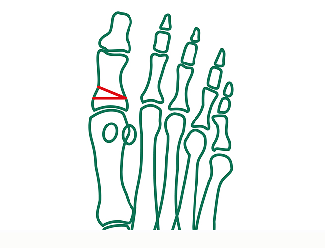 OSG 3-Phasen-Orthesen – Wuppertaler Fuß – Initiative